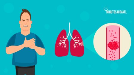 Embolia pulmonar: é grave? Veja o que é, causas e tratamento | MS