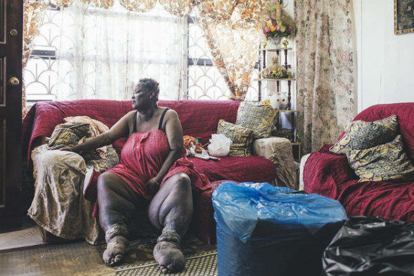 O que é Filariose, tipos, tratamento, prevenção, tem cura? | MS