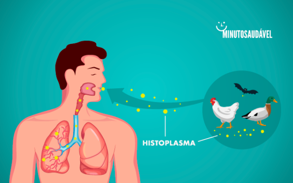 Histoplasmose: veja o que é, sintomas, prevenção, tratamento | MS