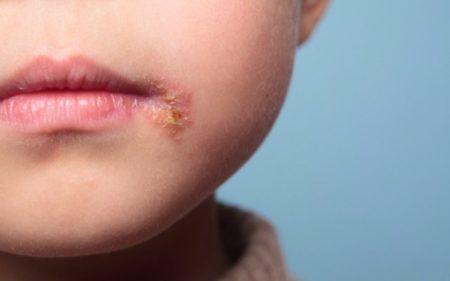 Herpes labial: como tratar (remédio e pomada)? Veja sintomas | MS