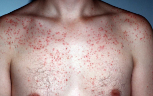 Foliculite: entenda as causas, como tratar e prevenir manchas | MS