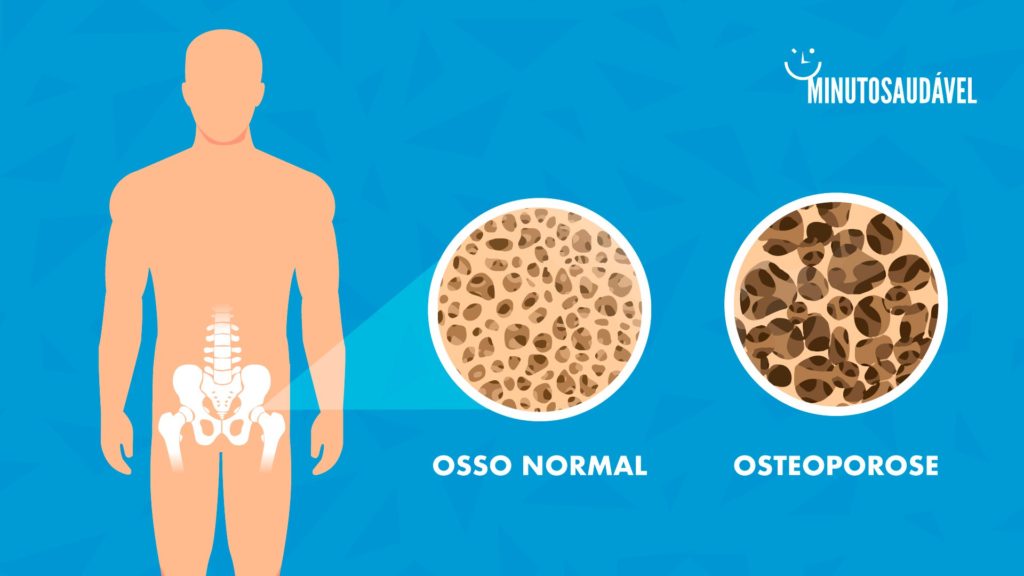 Osteoporose: o que é, sintomas e tratamentos. Tem cura? | MS