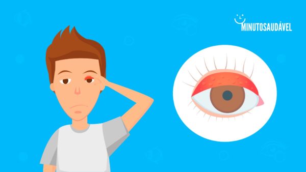 Tracoma: veja sintomas, transmissão, tratamento, prevenção | MS