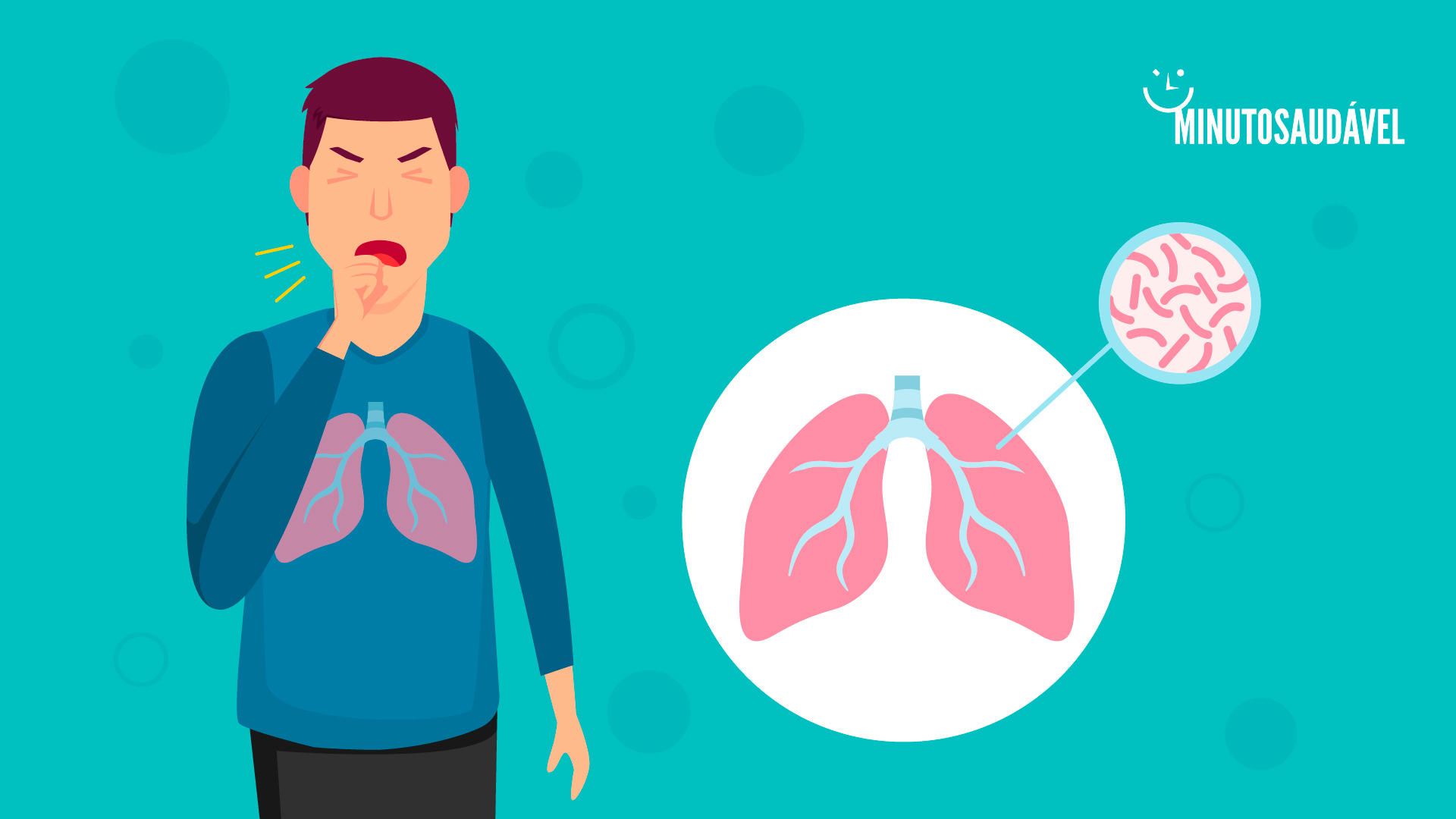 Tuberculose (ganglionar, pulmonar): o que é, sintomas, causa | MS