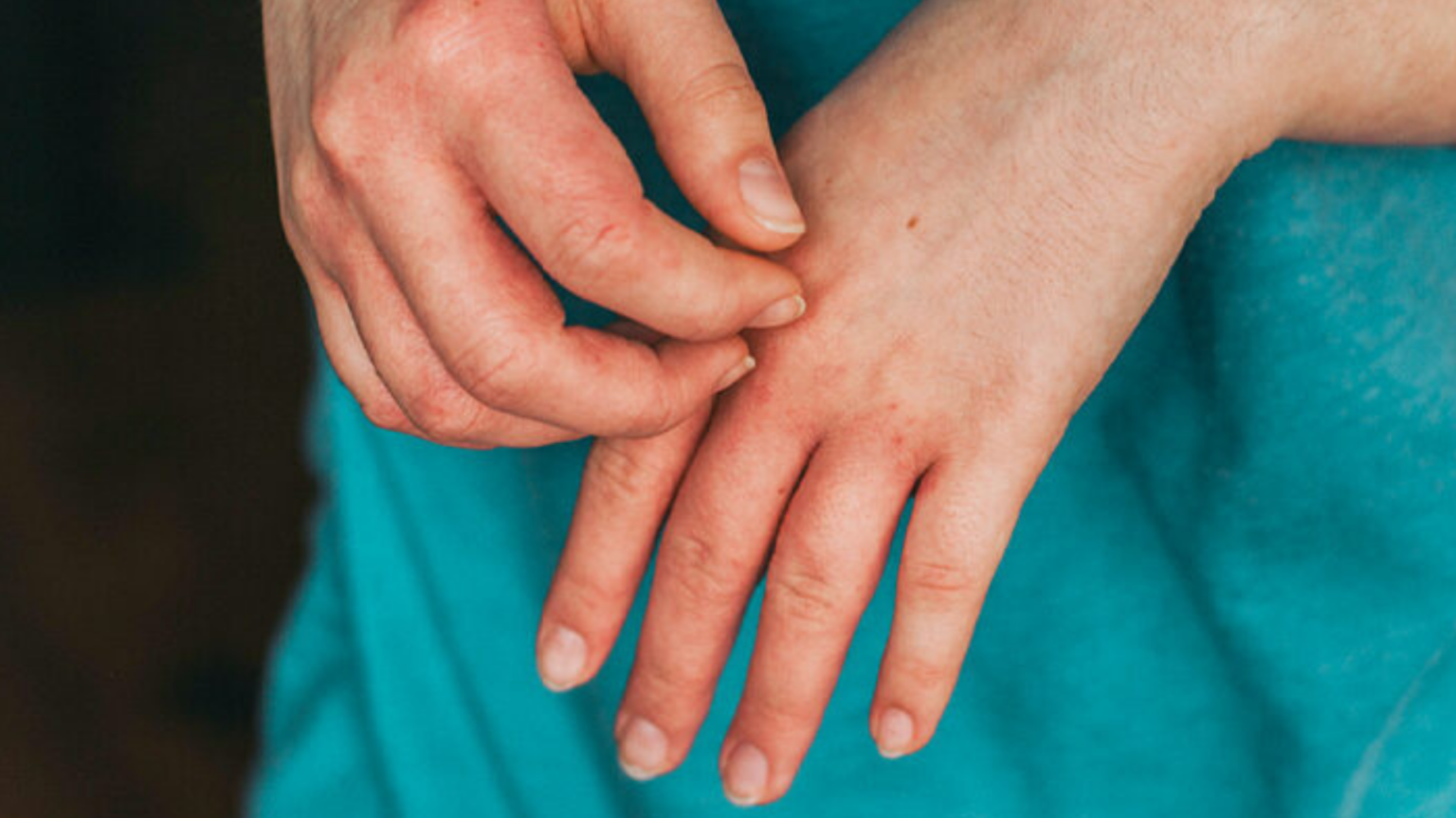 Disidrose: o que é? Quais as causas e tratamentos? | MS